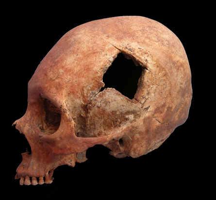 Incan skull surgery