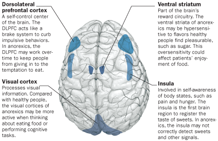 The Anorexic Brain