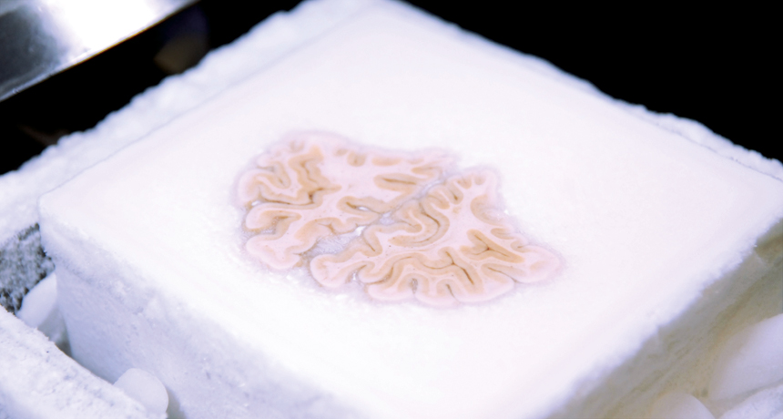 Famous brain surgery patient H.M. retained a chunk of hippocampus