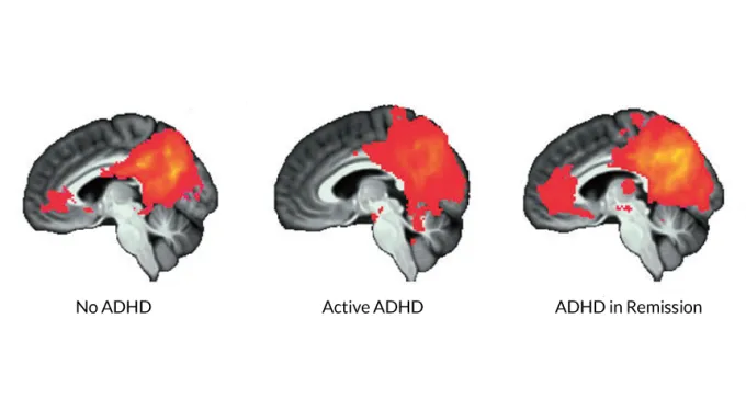 Brain signal reappears after ADHD symptoms fade