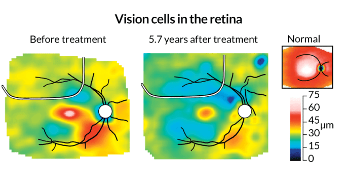 Gene therapy for blindness dims a bit