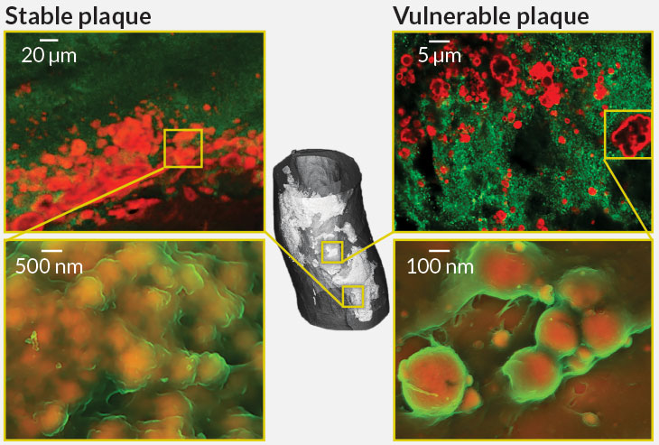 Images probe artery-hardening plaques
