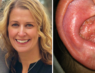 Shingles can hit hard and do lasting damage | Science News