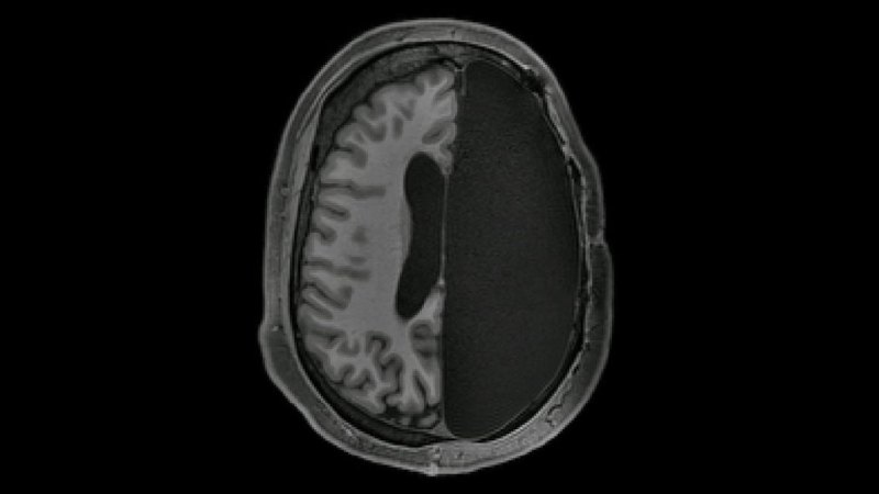 Some people with half a brain have extra strong neural connections