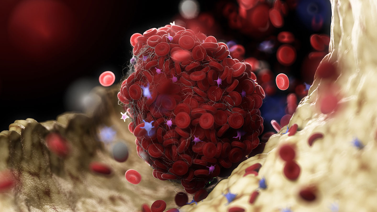 People with post-COVID-19 vaccine clots share a rare immune response ...
