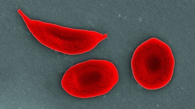 The first CRISPR therapy approved in the U.S. will treat sickle cell ...