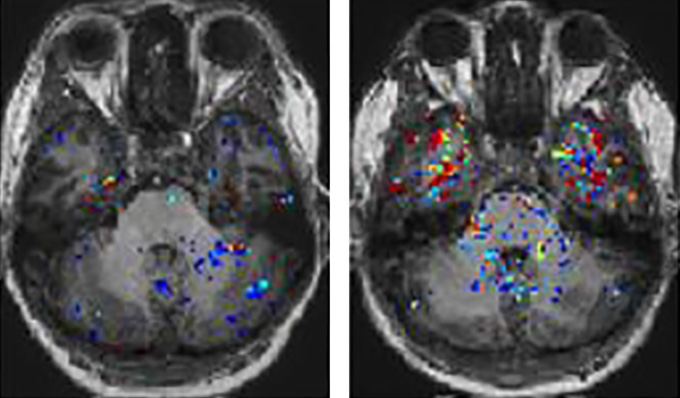 Long COVID brain fog may be due to damaged blood vessels in the brain