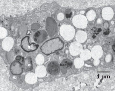 A new study has linked microplastics to heart attacks and strokes. Here ...