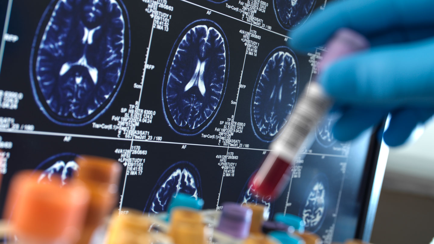 Alzheimer's blood tests are getting better, but still have a ways to go