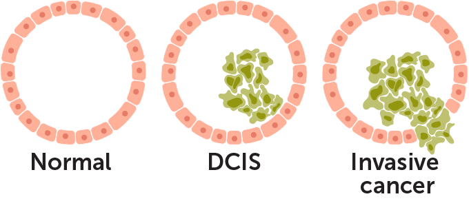 What is 'Stage 0' breast cancer and how is it treated?