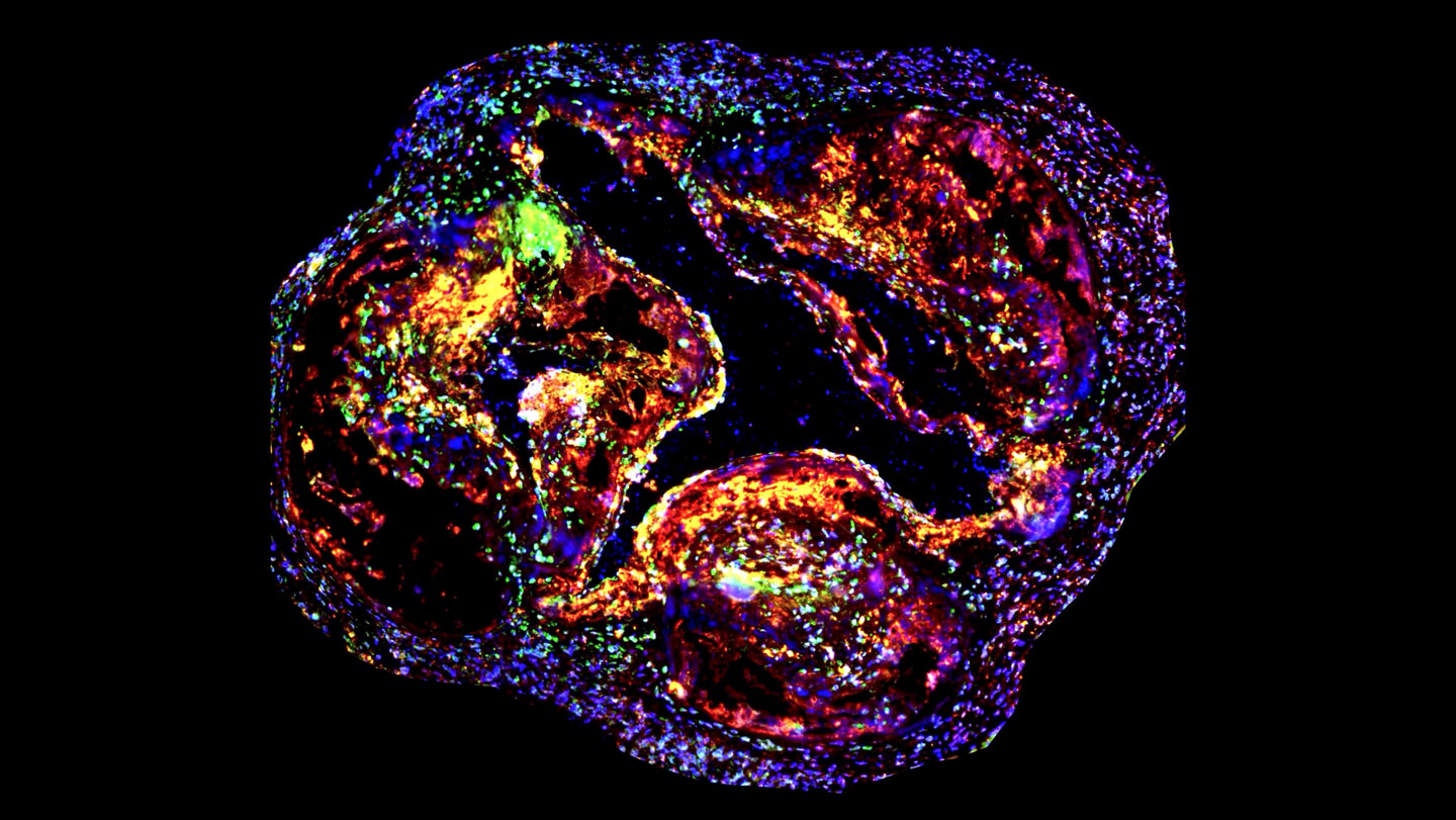 Sleep and exercise may dampen genetic drivers of heart disease